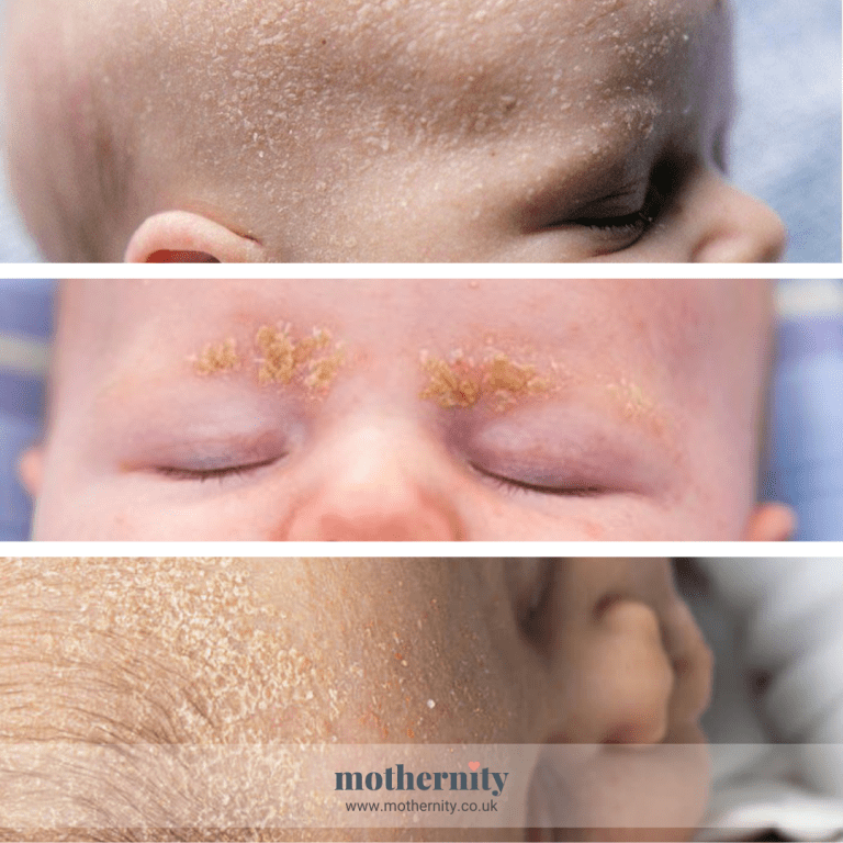Cradle cap or seborrheic dermatitis - Mothernity